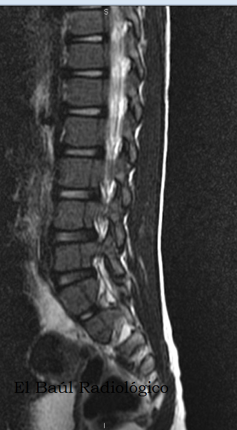 El Baúl Radiológico: SINCONDROSIS NEUROCENTRAL DE LOS CUERPOS ...