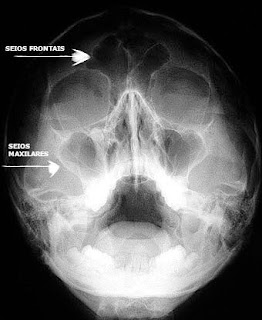 Resumo: Seios Paranasais - Radiologia e Concursos