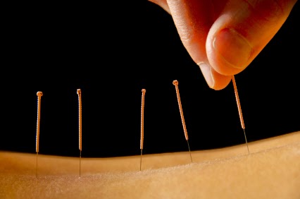 Acupuncture & Chinese Medicine: Acupuncture Explained, Part I