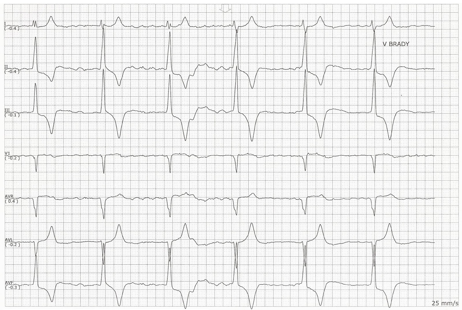 Atrial Fibrillation with Ventricular Escape Beats