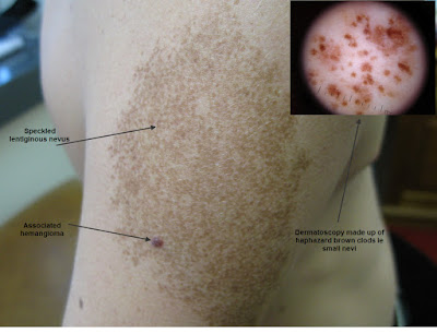 Dermpath Made Simple - Neoplastic: Benign Pigmented Lesions - Solar ...