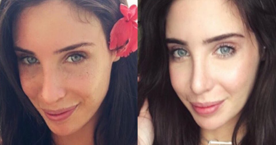 TL PLASTIC SURGERY CLINIC KOREA: Jutting chin reduction