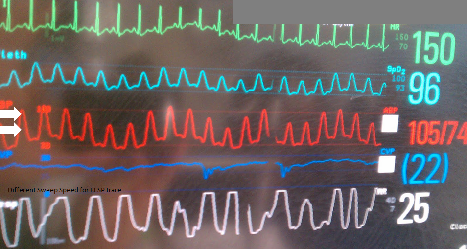 PediCardiology Quiz: Quiz #17: Arterial pulse trace
