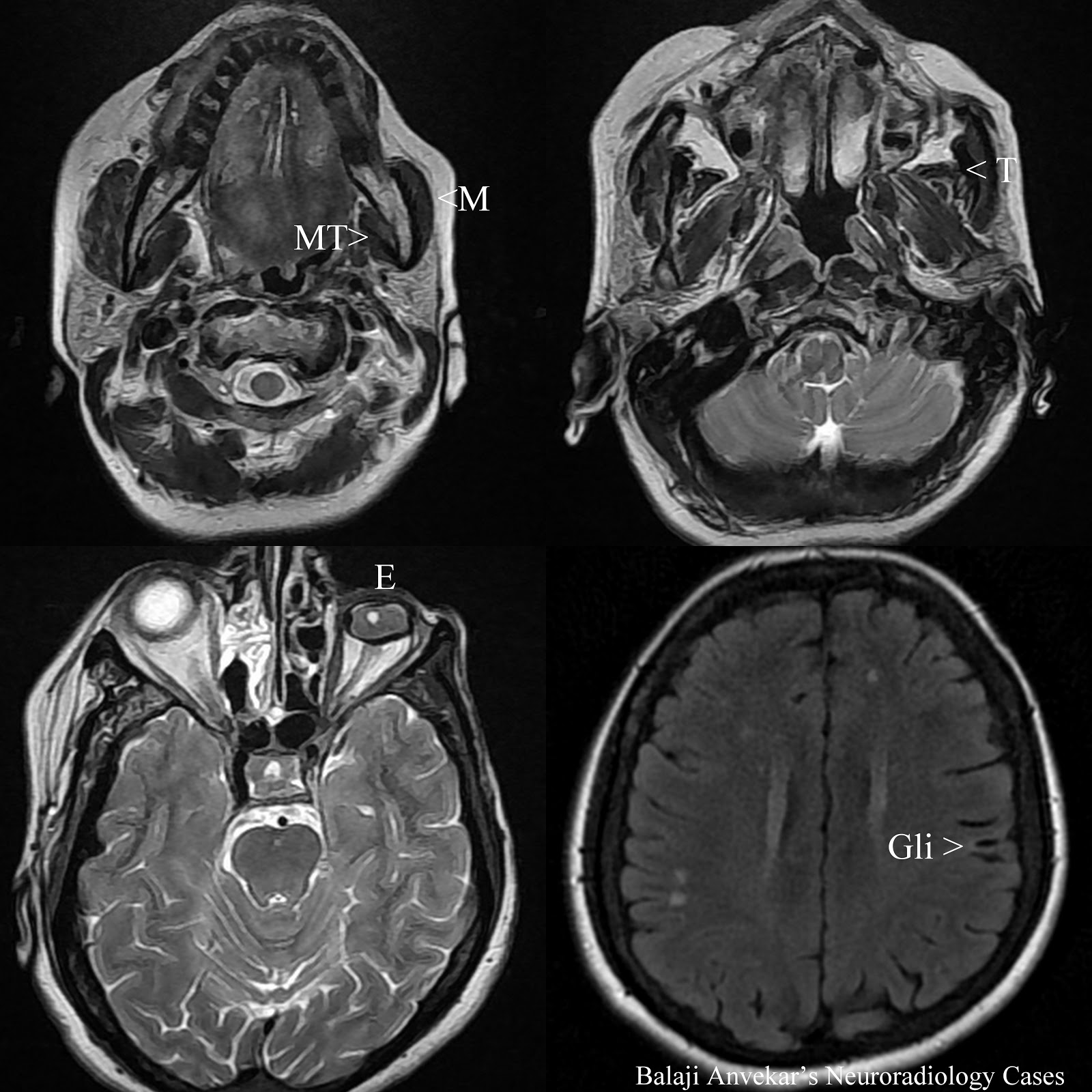 Dr Balaji Anvekar FRCR: Parry Romberg Syndrome