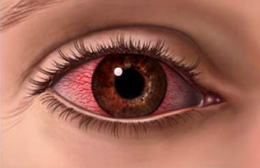 Chemical conjunctivitis