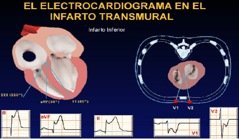 Electrocardiograma infarto transmural inferior