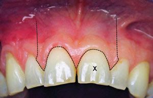 dental: Flap Design on oral surgery