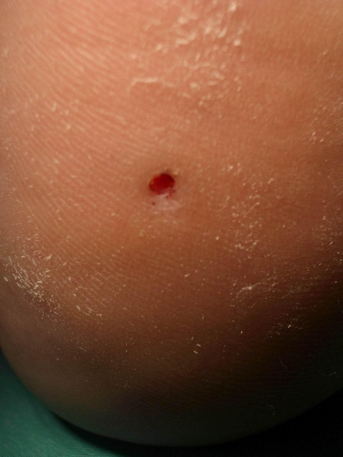 Podo Basas al Día: Fascitis plantar. Micosis intertriginosa. Papiloma ...