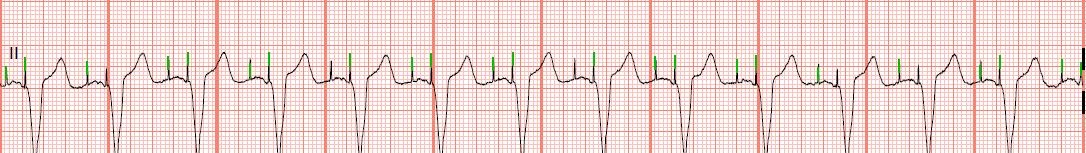 EKG Rhythm Strip Quiz 56: Paced Rhythms