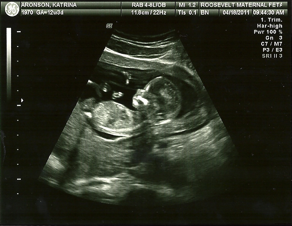 pregnantista: hospital sonogram (nuchal translucency) - 13 weeks