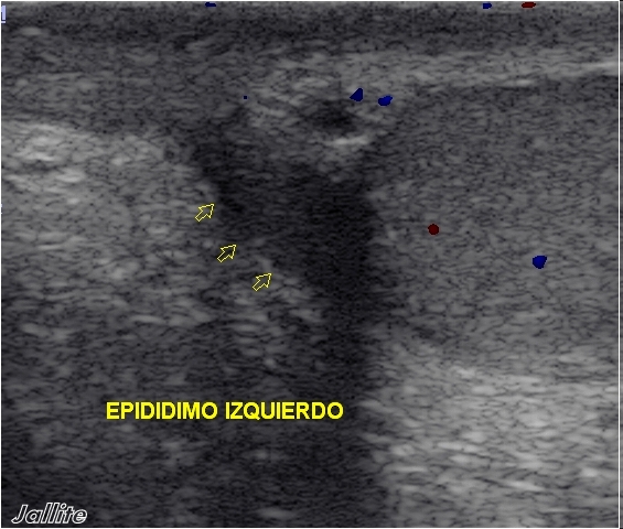 Engrosamiento Escrotal post Absceso