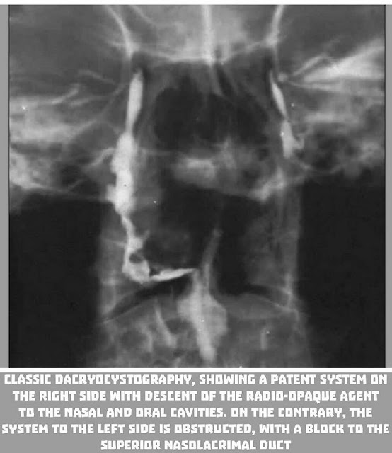 The watery eye, its common cause, and step wise approach - Eye Health Nepal