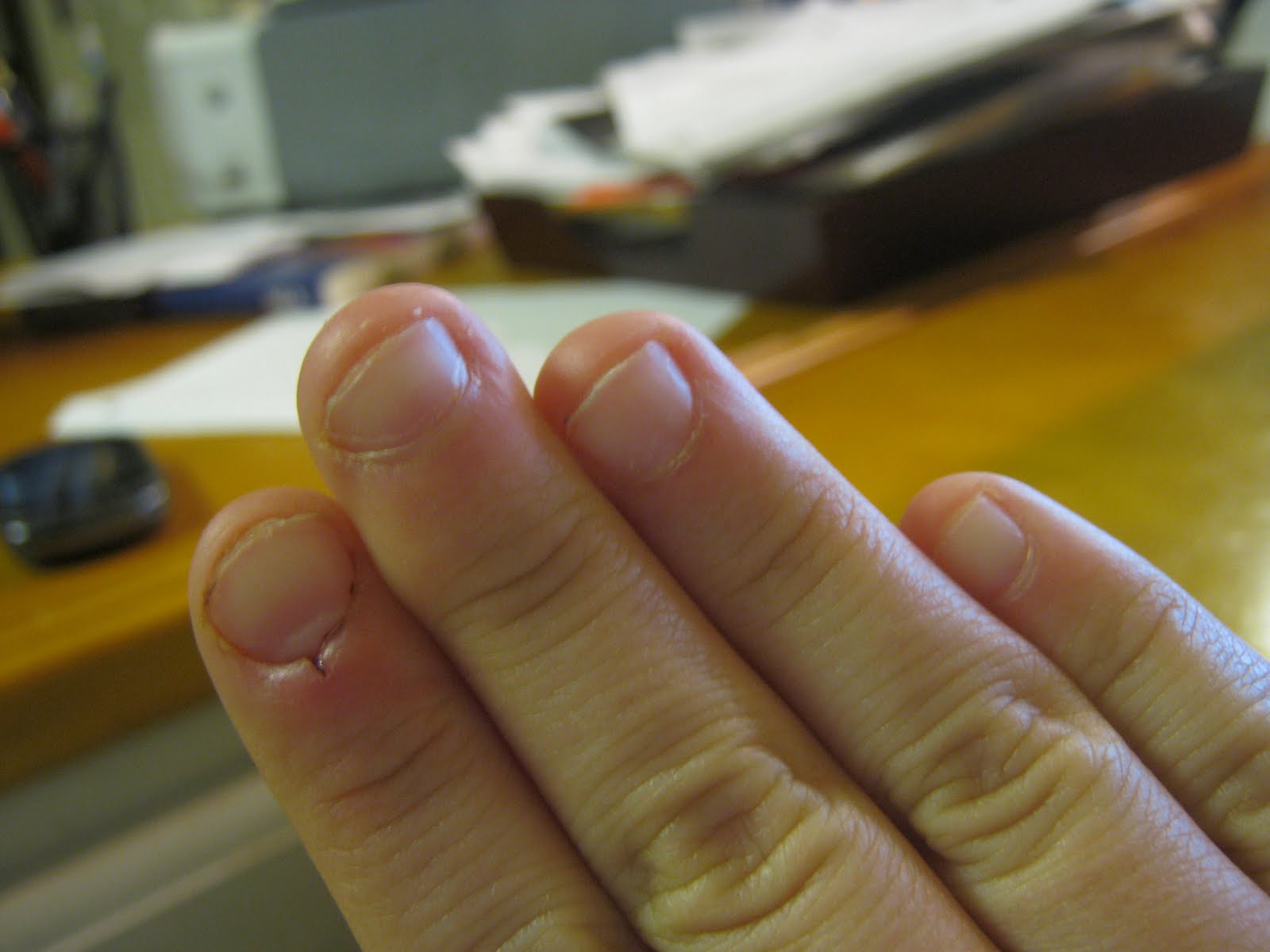 Sincerely, Sidney: Poor Stubby Things That Need To Kick The Habit