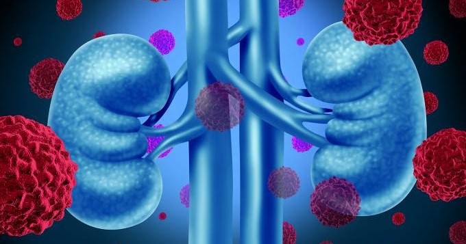 SAÚDE CANAL DA VIDA: O câncer de rim e o acesso a novos tratamentos ...