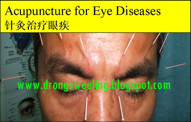 TCM News: Can TCM Cure Eyes Diseases? Such as Glaucoma, Age-related ...