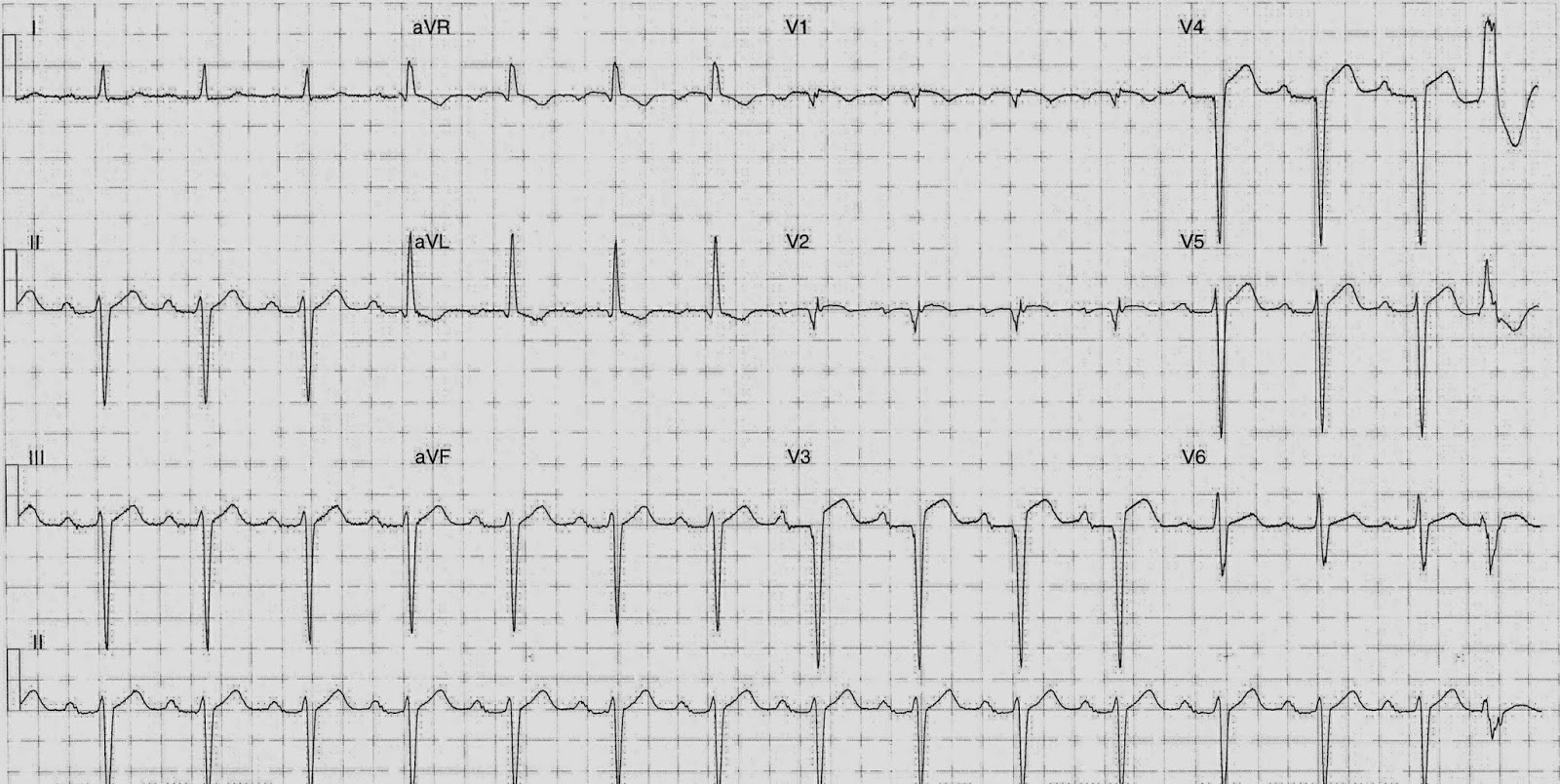 ECG of the Week: ECG of the Week - 3rd March 2014 - Interpretation