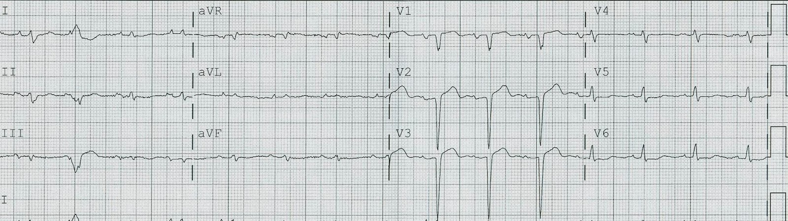 Dr. Smith's ECG Blog: Left ventricular Aneurysm Morphology Distorted by ...