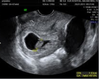 CYST KETIKA HAMIL, APA PATUT SAYA BUAT? - Jom Lebih Sihat!