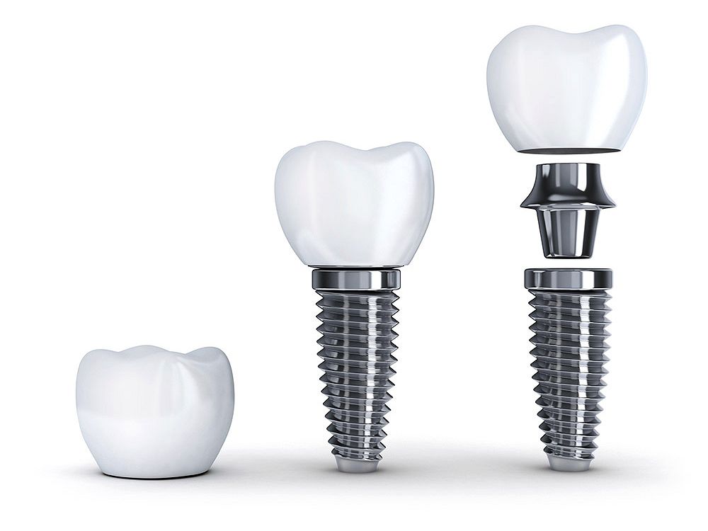 Tire suas dúvidas sobre implantes dentários | Directorio Odontológico