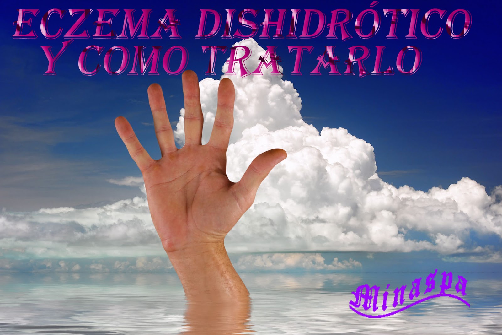 ECZEMA DISHIDRÓTICO Y CÓMO TRATARLO