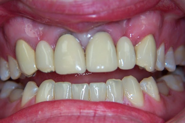 The Dental Tourist: 34: PFM=NO, PFZ=NO, PZ=Si!
