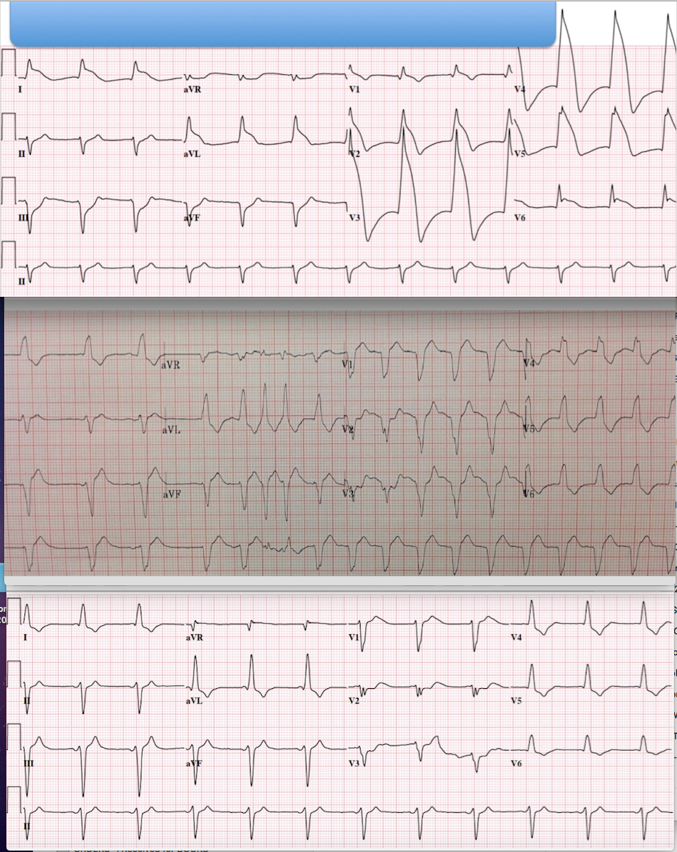 My Other Pages ...: Giant (Shark-Fin) R Waves — Acute Anterior STEMI ...