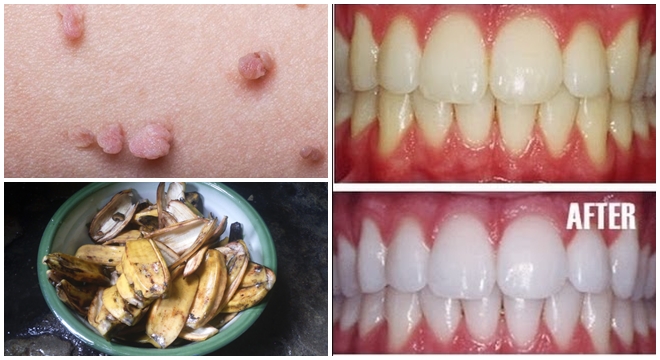 Sungguh Mengagumkan! Kulit Pisang Mampu Memutihkan Gigi, Menghilangkan ...
