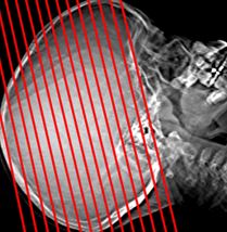 Dr Herry Setya Yudha Utama SpB. FInaCS. MHKes. ICS: Seri Bedah Saraf ...