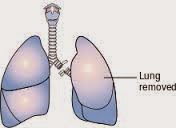Medical Treatment Pictures-for Better Understanding: Pneumonectomy ...