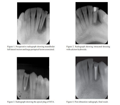 PDF: Complicated crown fracture: a case report - Ovi Dental