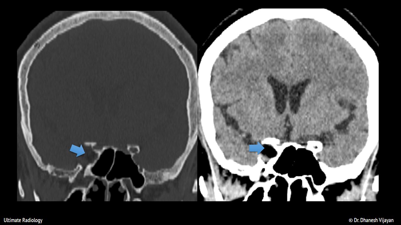 Ultimate Radiology : Cavernous Sinus Dermoid Cyst