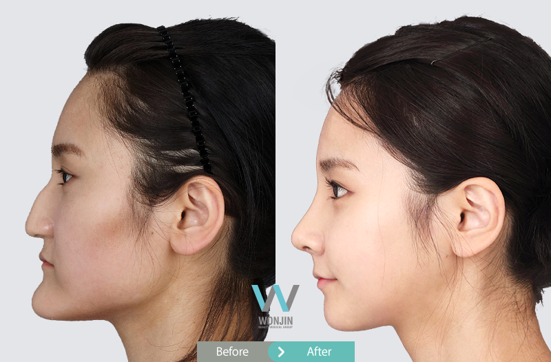 Mulut yang Maju dapat Diperbaiki dan Diobati dengan Operasi Dua Rahang