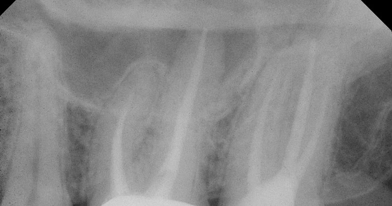 The Endo Blog: Cone Beam CT in Endodontic Diagnosis