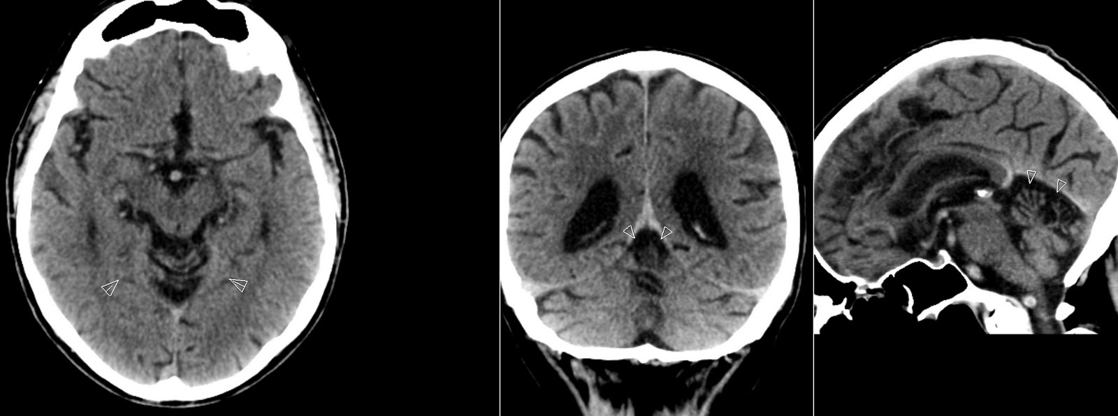 Alcohol Related Upper Vermis Atrophy