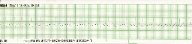 EKG Rhythm Strip Quiz 15