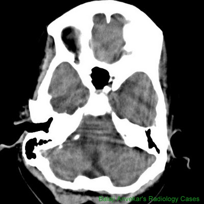 Dr Balaji Anvekar FRCR: Intracranial calcifications