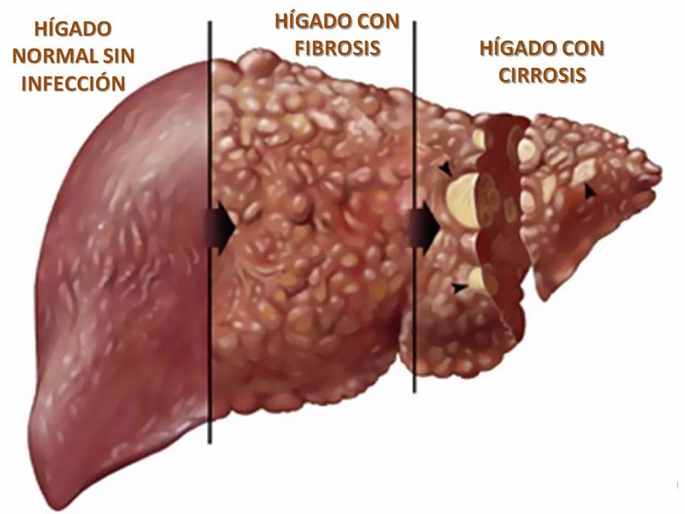HEPATIC DISORDERS