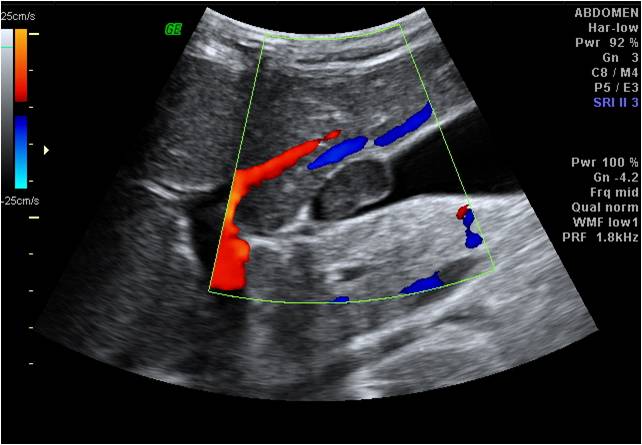 Gall Bladder Wall Cyst [ Possibly Submucous Cyst ]: An Ultrasound ...