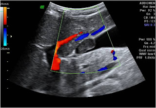 Gall Bladder Wall Cyst [ Possibly Submucous Cyst ]: An Ultrasound ...