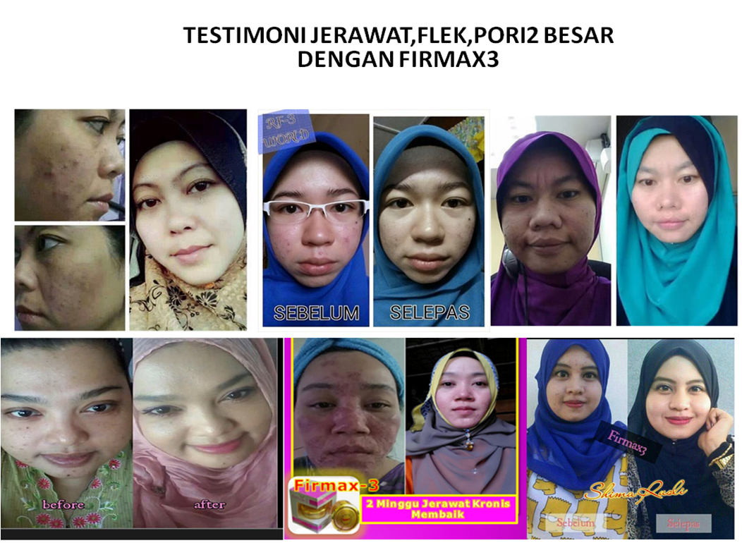 TESTIMONI PENGGUNAAN FIRMAX3 ~ Cream Ajaib "Firmax3"
