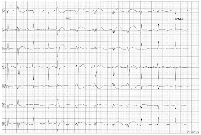 Sinus Rhythm with Ventricular Escape Beats