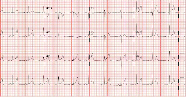 ACLS review: Acute Coronary Syndromes Part 5
