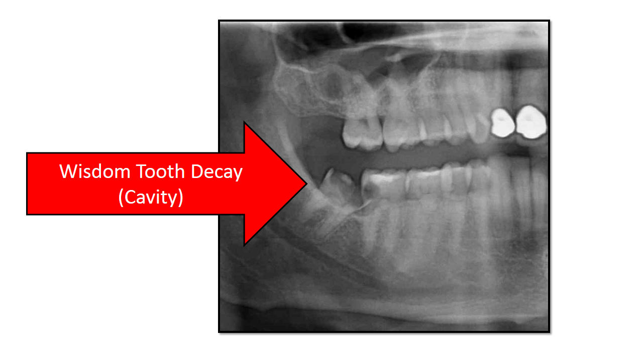 Wisdom Teeth and Other Extractions