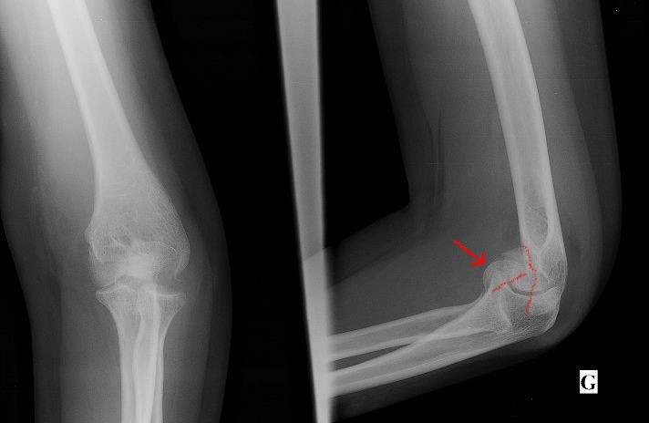 Un Jour En Chirurgie Orthopedique Et Traumatologique: Fracture rare du ...