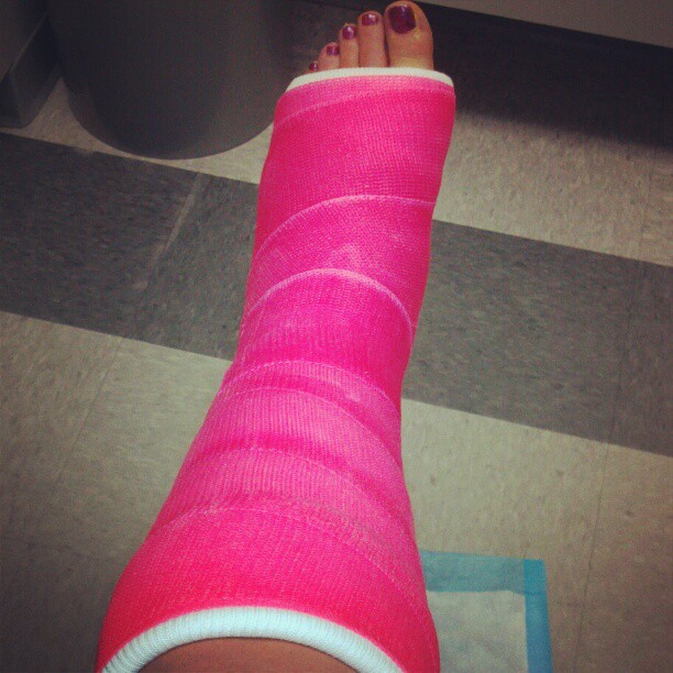 Casts and Toes: Random Cast Pics