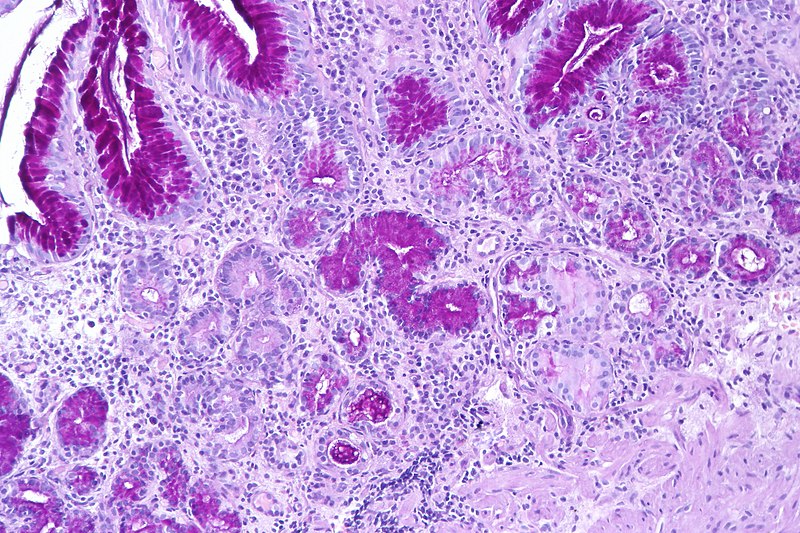 Autoimmune gastritis