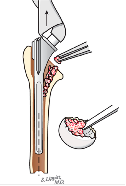 UW Shoulder and Elbow Academy: Fixation of the humeral component with ...
