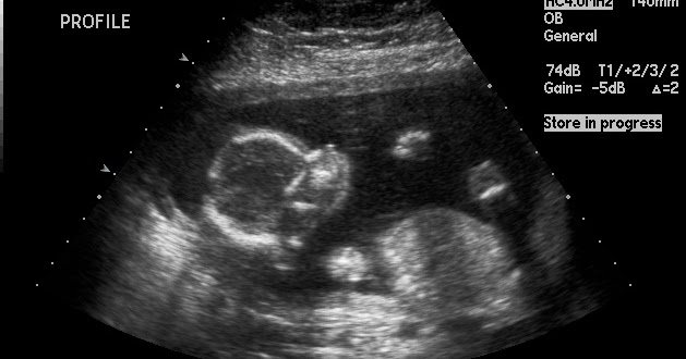 My Unfiltered Chaos: The Pregnancy Chronicles: 24 Weeks AND Name Reveal