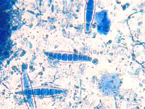 DERMATOPHYTOSIS | All Microbes