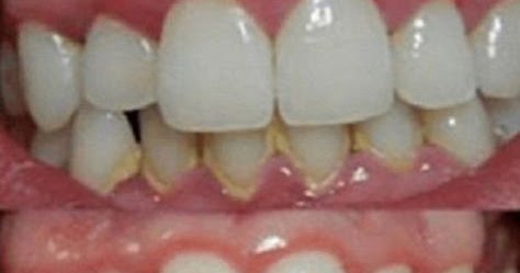 NO MORE BAD MOUTH SMELL, TARTAR, PLAQUE – USE THIS HOME TOOTHPASTE AND ...